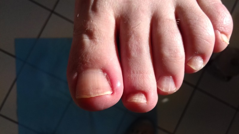 Ongle incarné: prise en charge par le traitement, les conseils et le ...